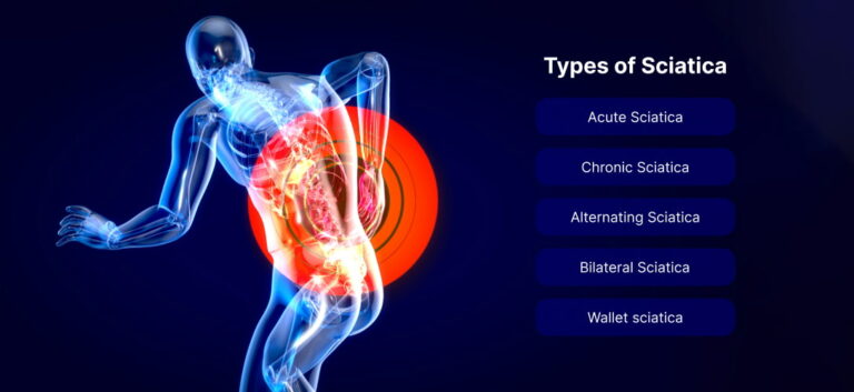 5 Types of Sciatica - All Injury Rehab